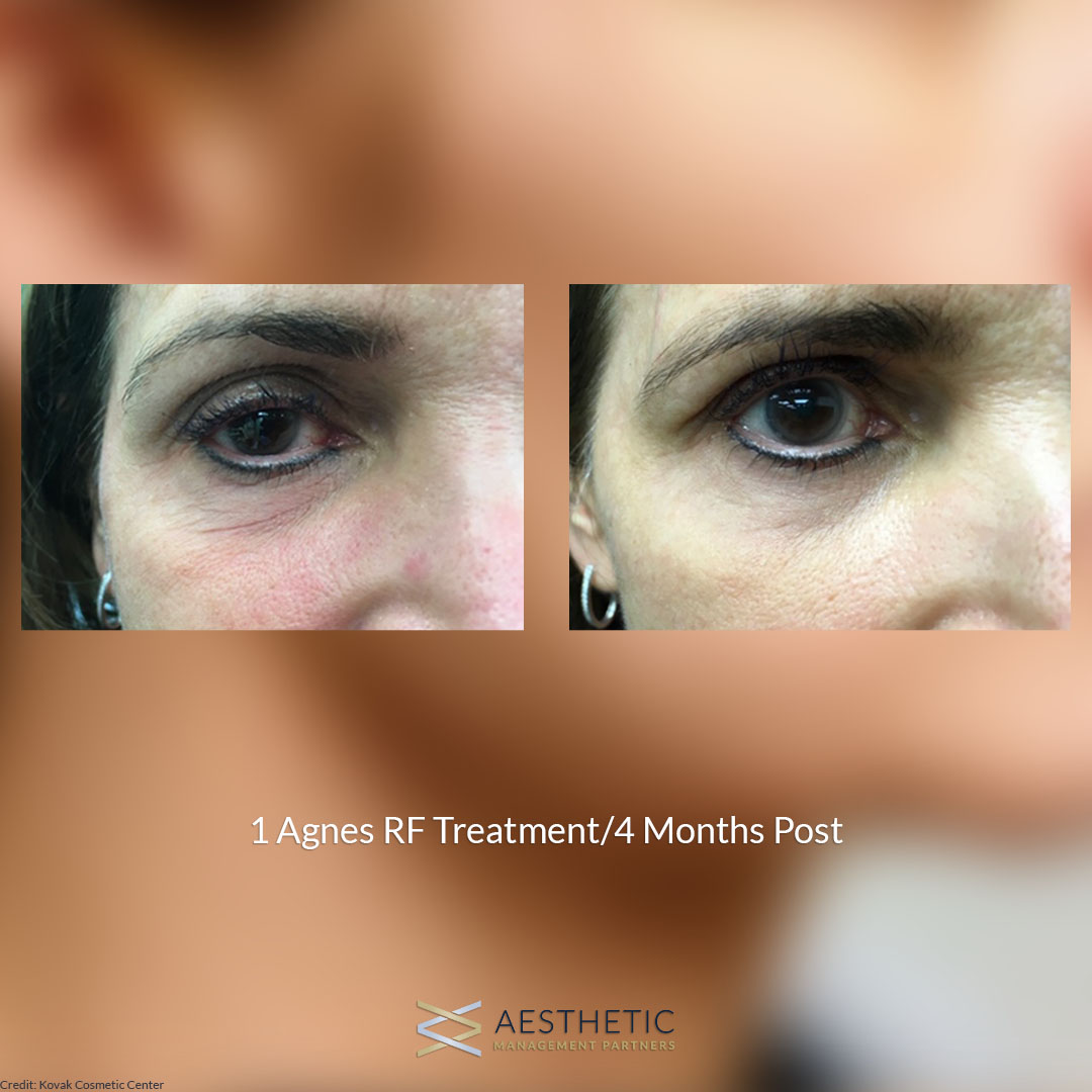 Agnes Rf Microneedling Plastic Surgeon In New Rochelle Ny